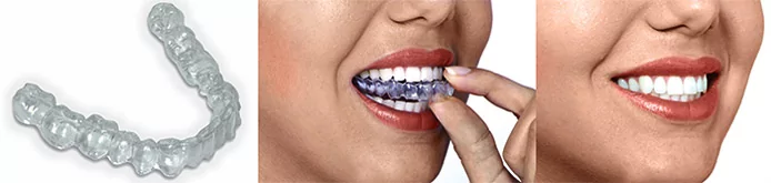 ClearCorrect Clear Braces | Distinctive Densitry - Edmonds, WA